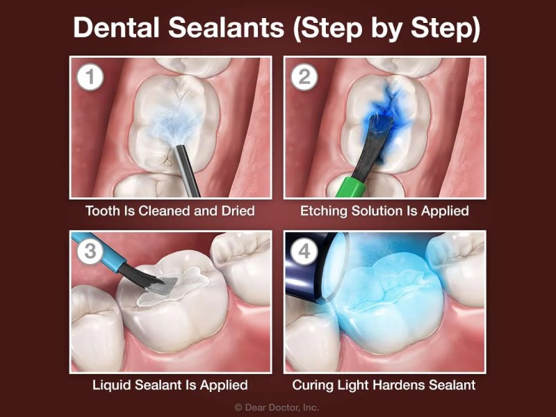What are Sealants for Teeth: Essential Dental Protection – Home Improvement Way
